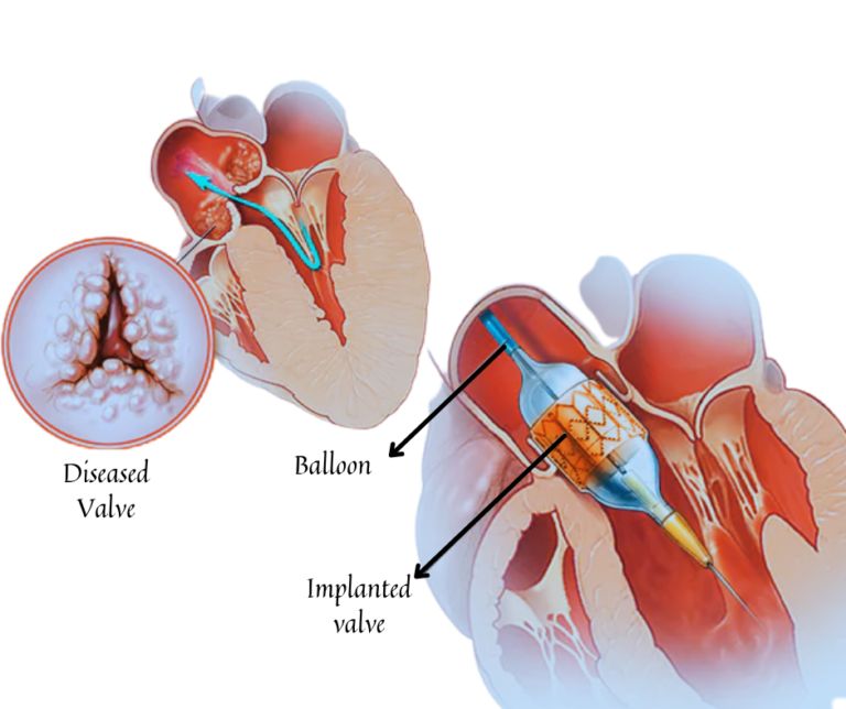 Keyhole Transcatheter Aortic Valve Replacement (TAVI) – HealthNactive